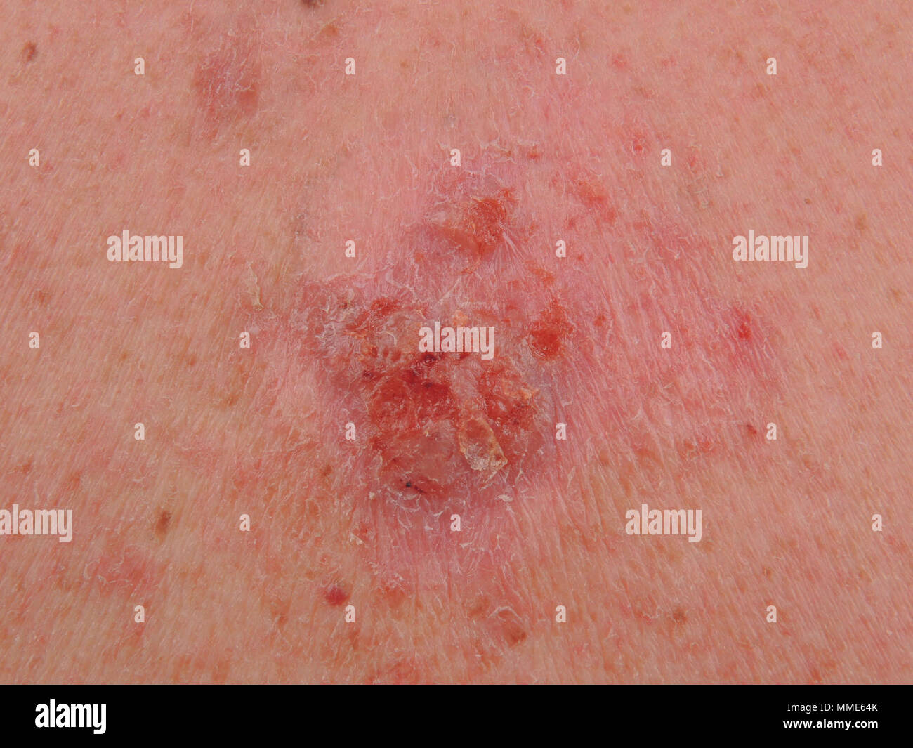 BASAL CELL CARCINOMA Stock Photo - Alamy