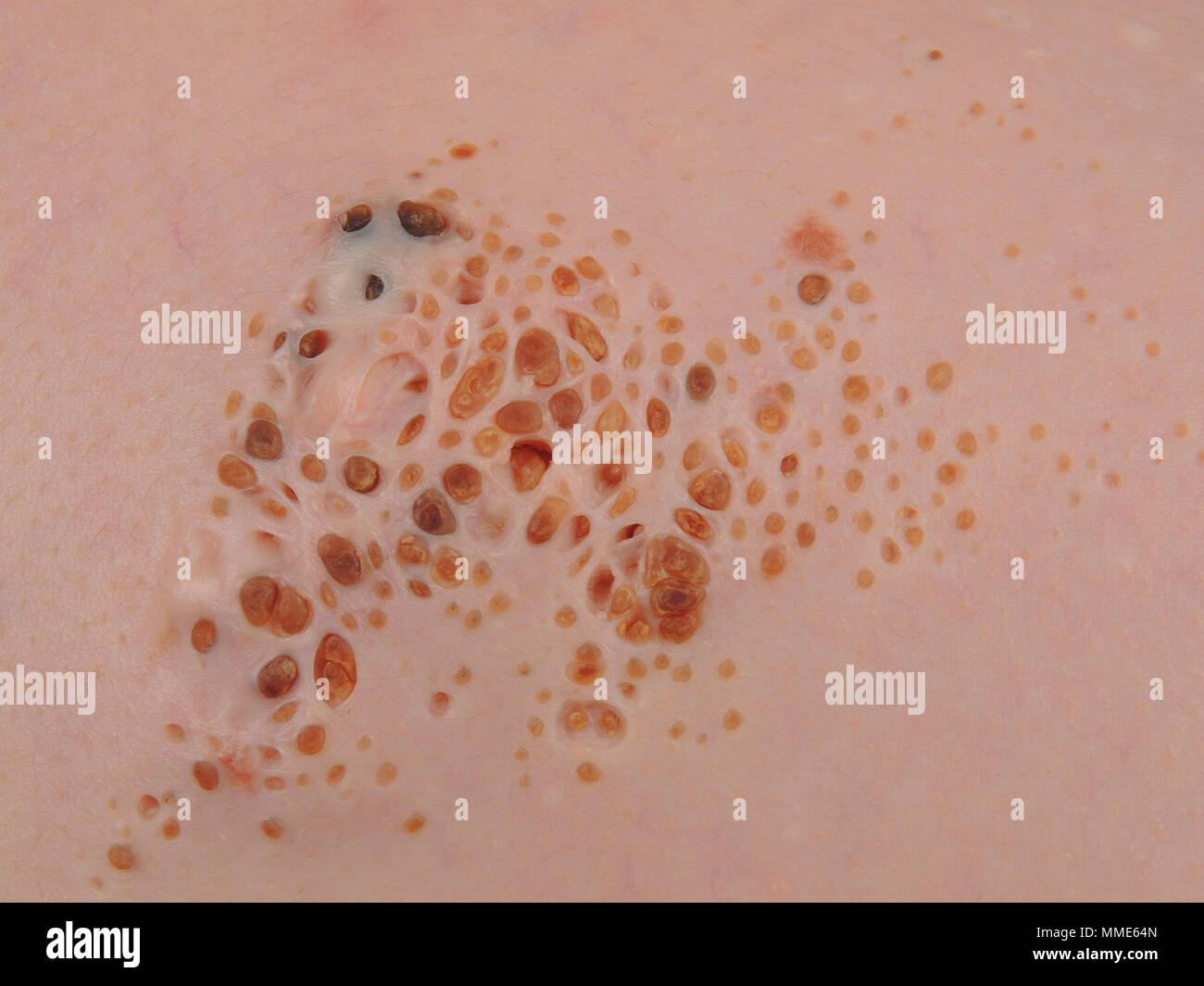 Cutaneous High Resolution Stock Photography and Images - Alamy