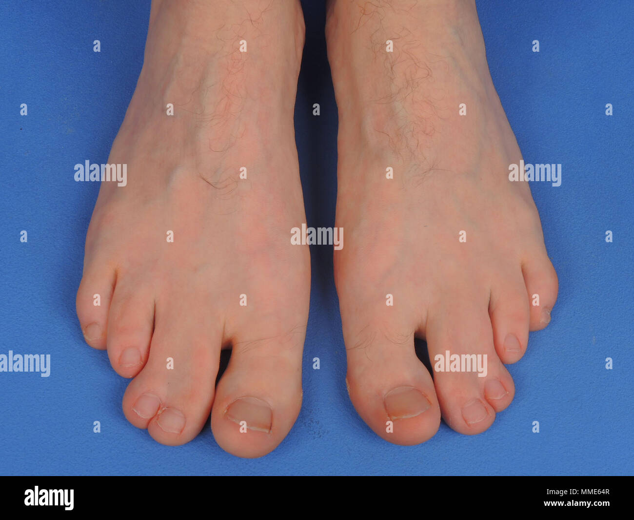 Syndactyly hi-res stock photography and images - Alamy