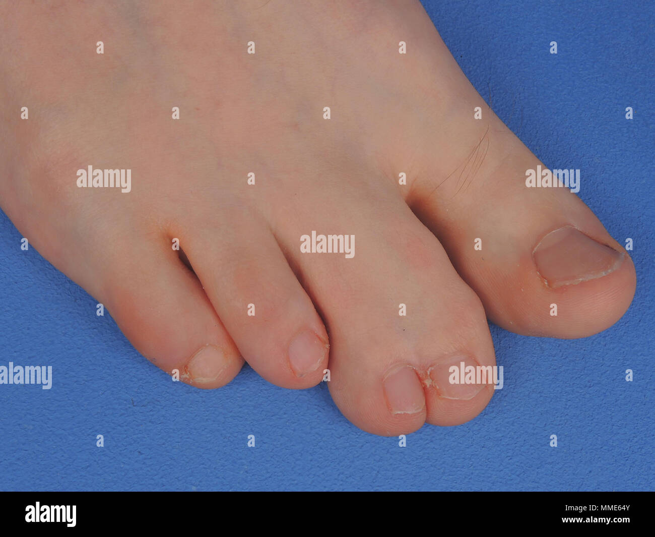Syndactyly hi-res stock photography and images - Alamy