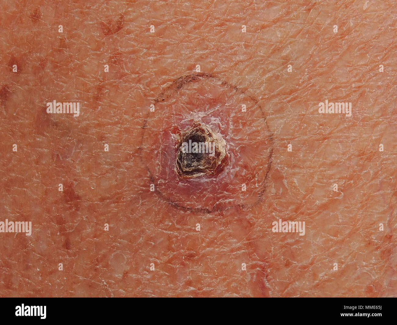 Basal cell carcinoma hi-res stock photography and images - Alamy