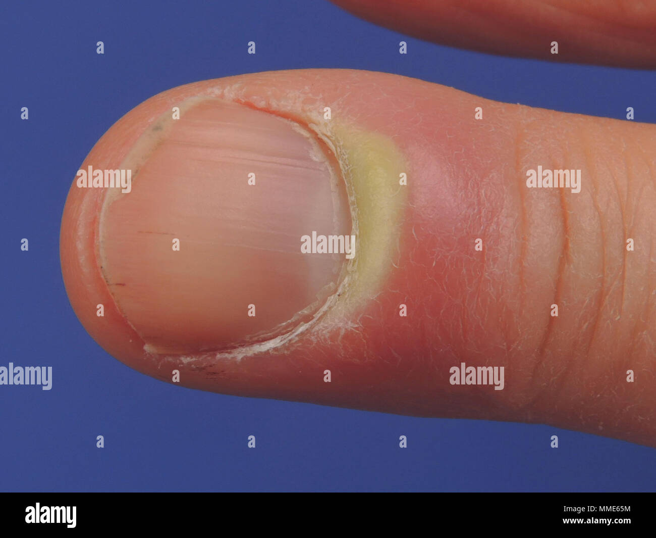 Onychia hi-res stock photography and images - Alamy