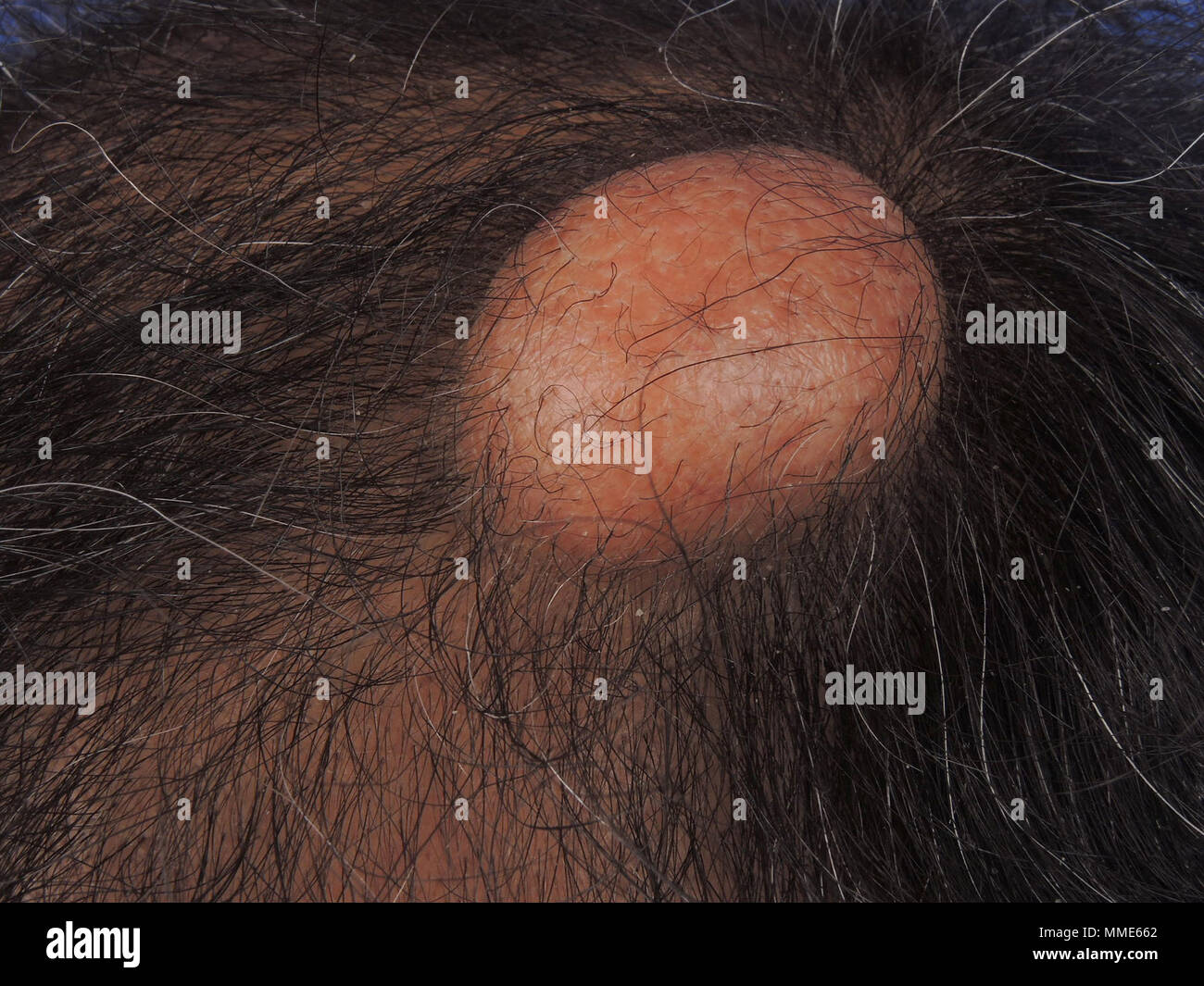 Sebaceous cysts hi-res stock photography and images - Alamy