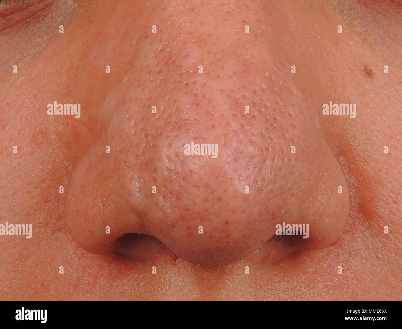 Syringoma hi-res stock photography and images - Alamy