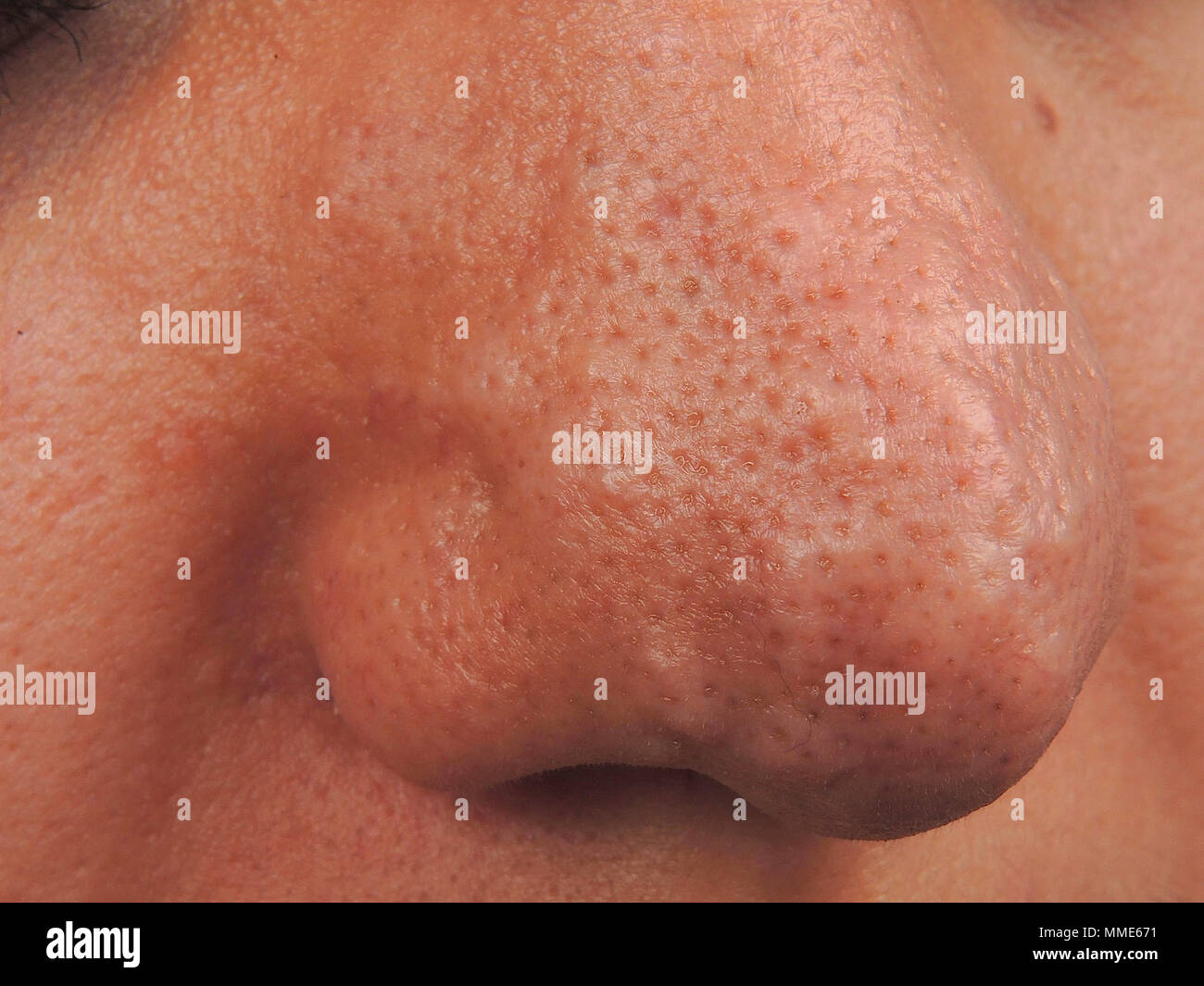 Sweat gland hi-res stock photography and images - Alamy