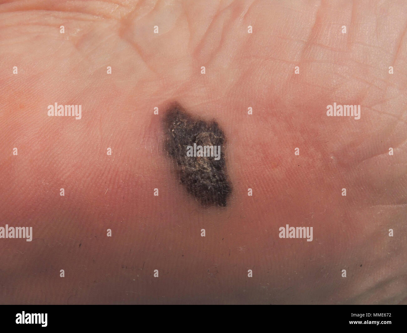 Melanomas hi-res stock photography and images - Alamy