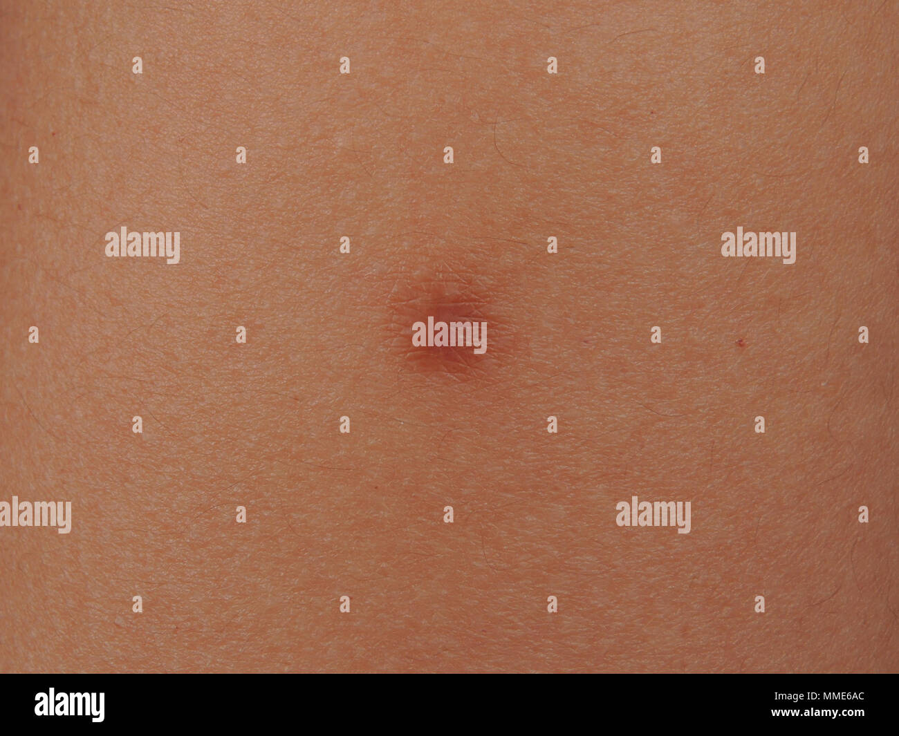 Fibrous histiocytoma hi-res stock photography and images - Alamy