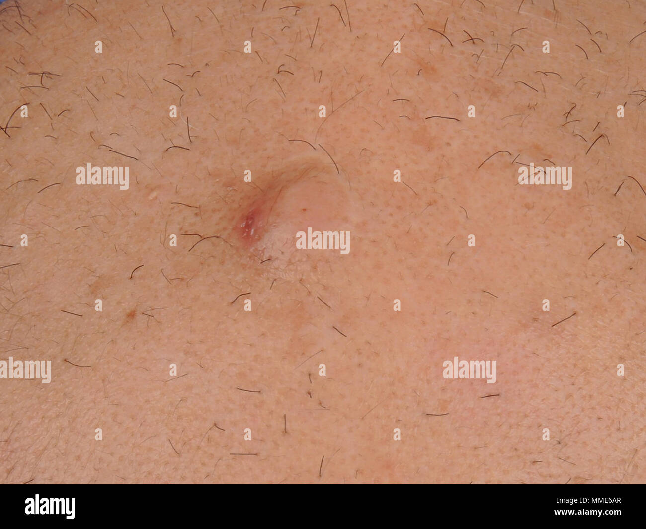 Epidermoid cyst hi-res stock photography and images - Alamy