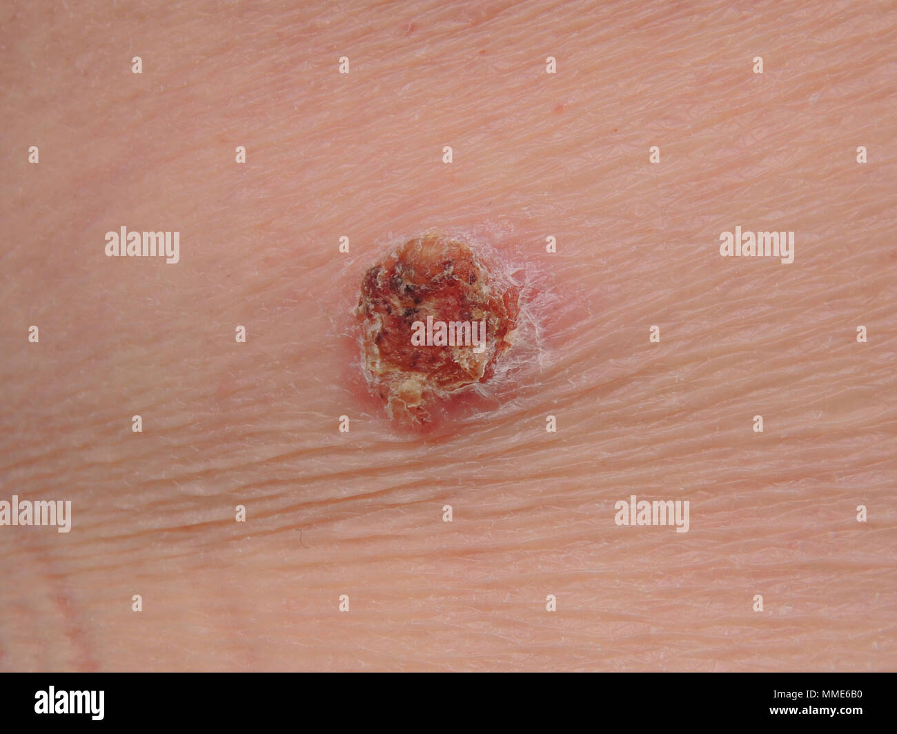 Bowens disease disease hi-res stock photography and images - Alamy