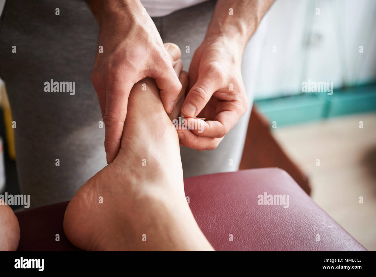 Acupuncture Feet High Resolution Stock Photography and Images - Alamy