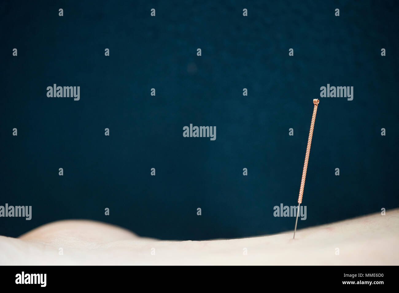 Single needle acupuncture hi-res stock photography and images - Alamy