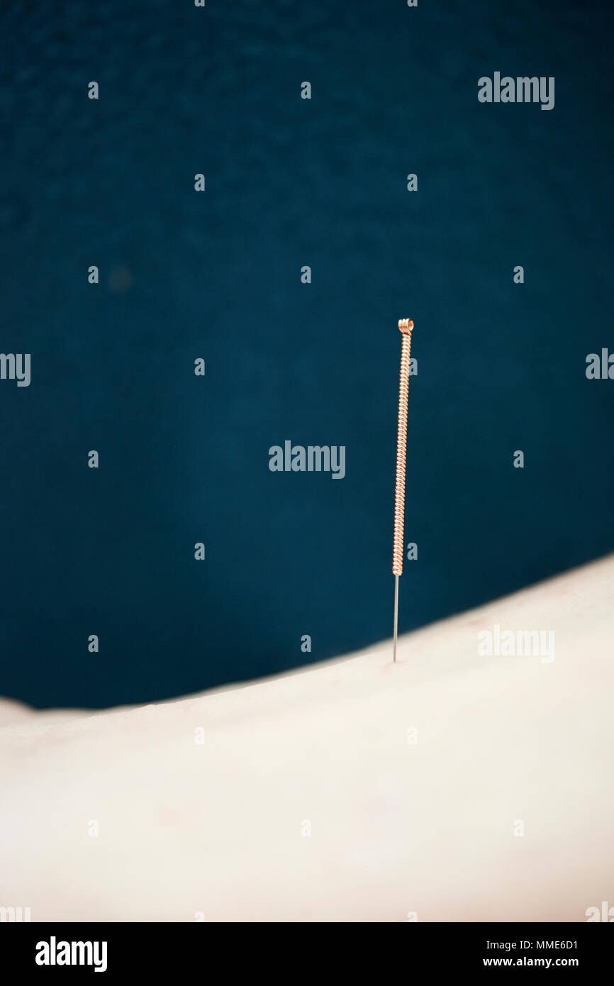 Single needle acupuncture hi-res stock photography and images - Alamy