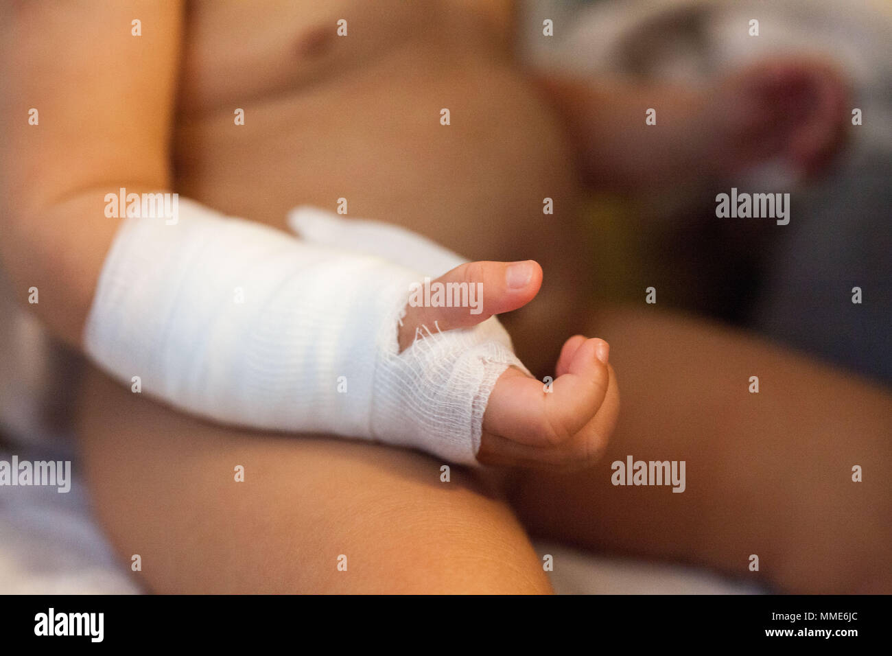 Burn injury child hi-res stock photography and images - Alamy