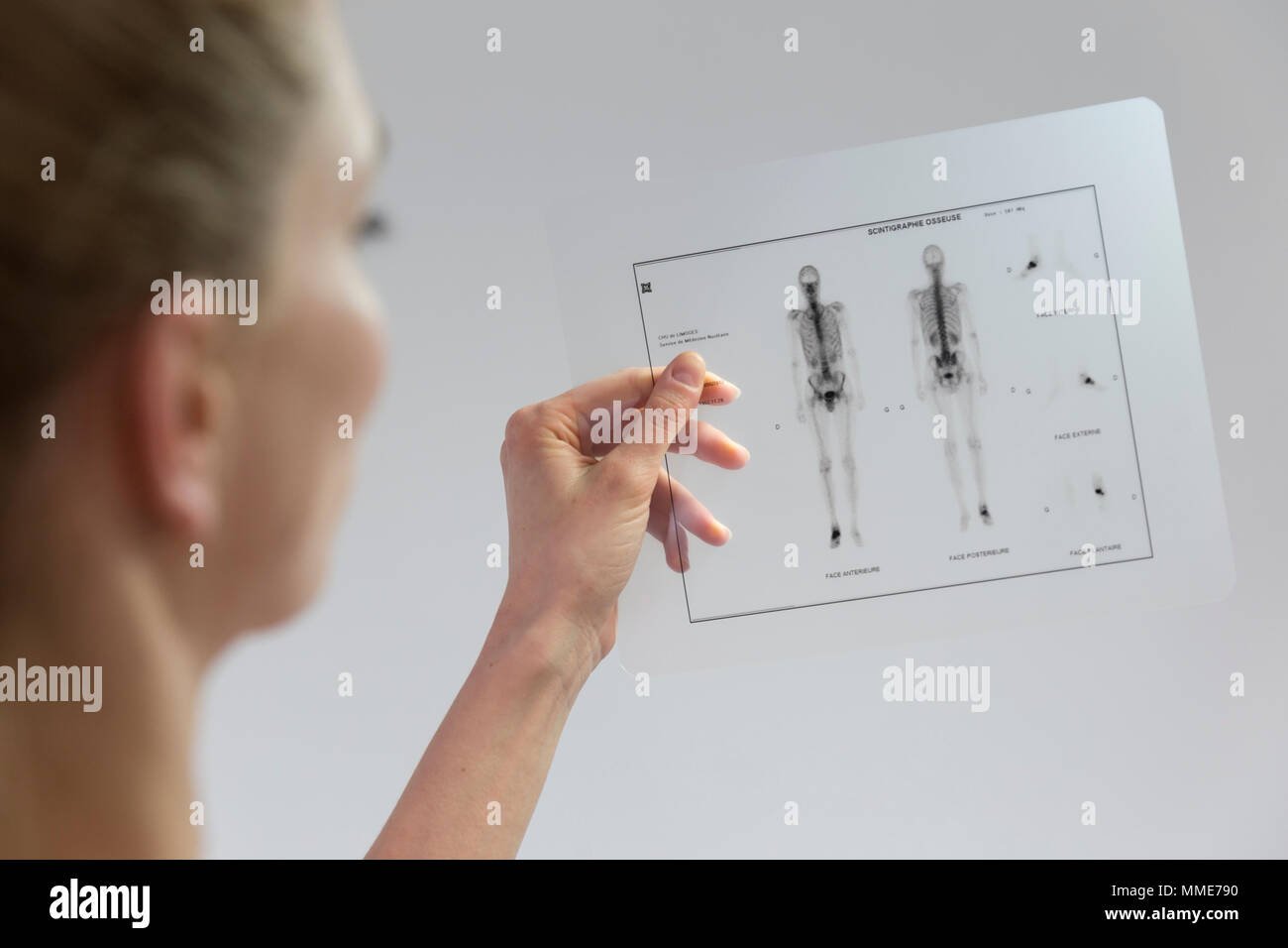 Bone scintigraphy hi-res stock photography and images - Alamy