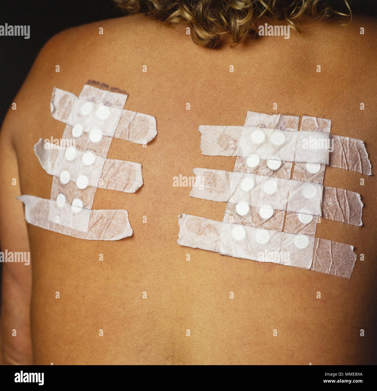 Inflammation of the epidermis hi-res stock photography and images - Alamy