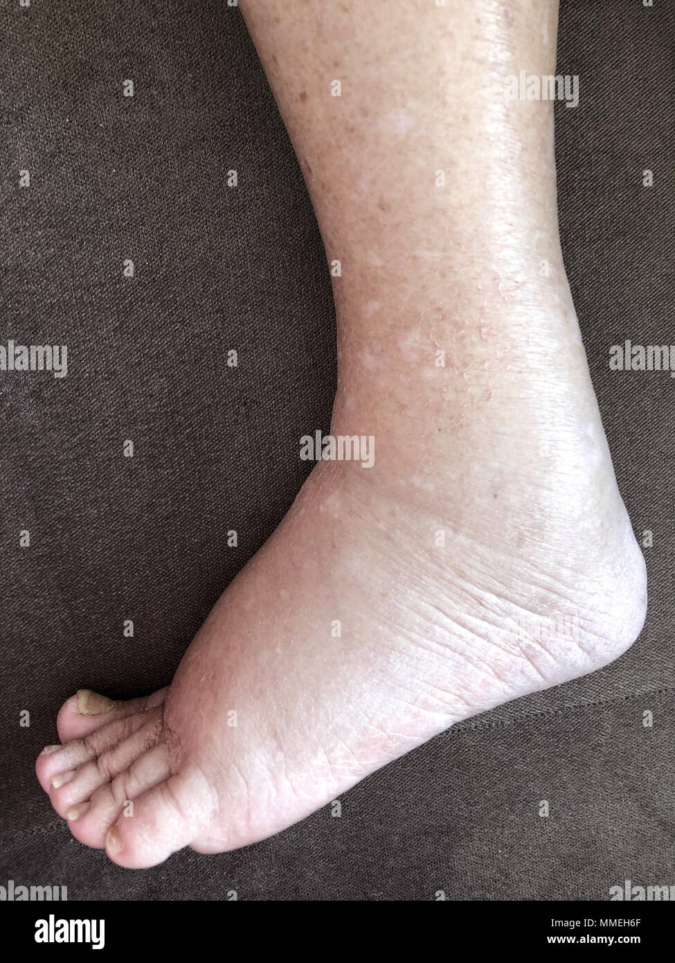 Closeup foot of diseased female patient who suffers from edema illness ...