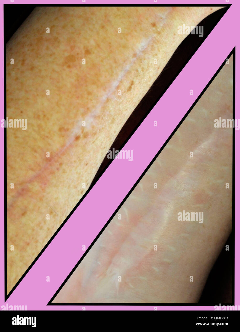 Surgical scars hi-res stock photography and images - Alamy