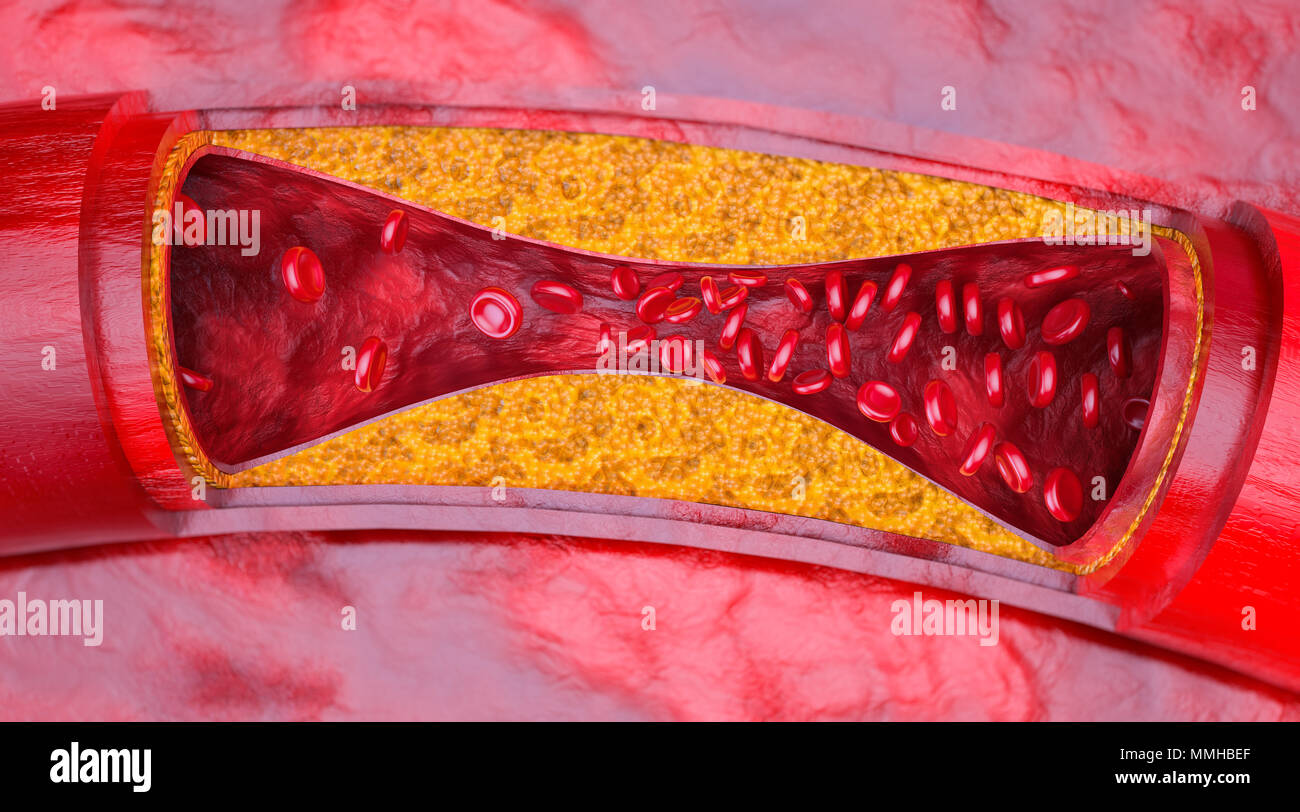 Atherosclerosis hi-res stock photography and images - Alamy