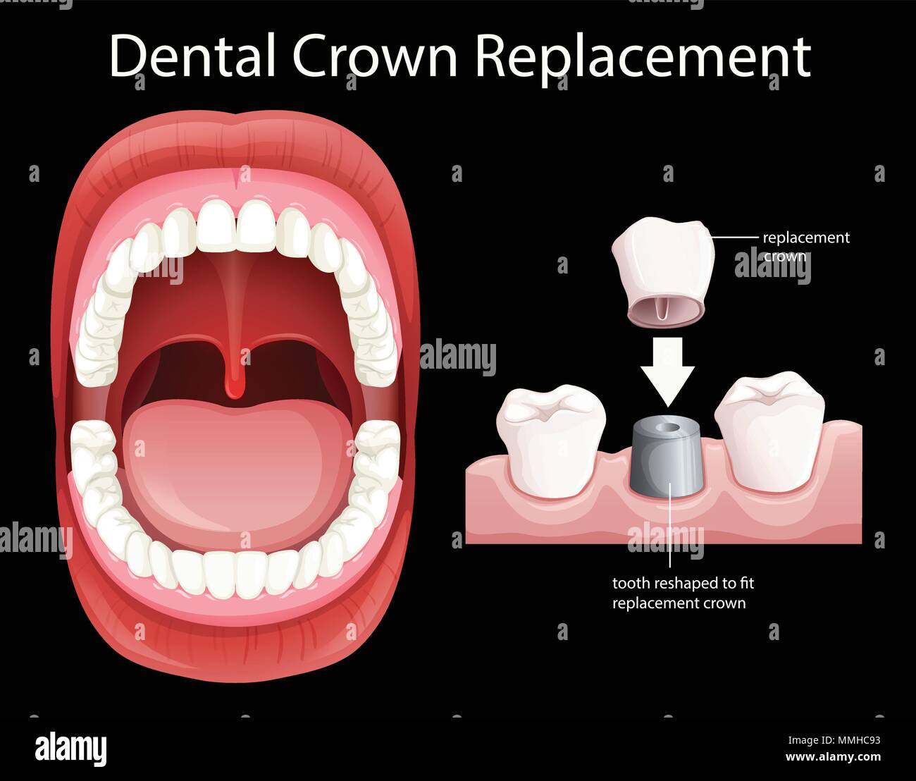 Human Mouth Dental Crown Replacement illustration Stock Vector Image ...