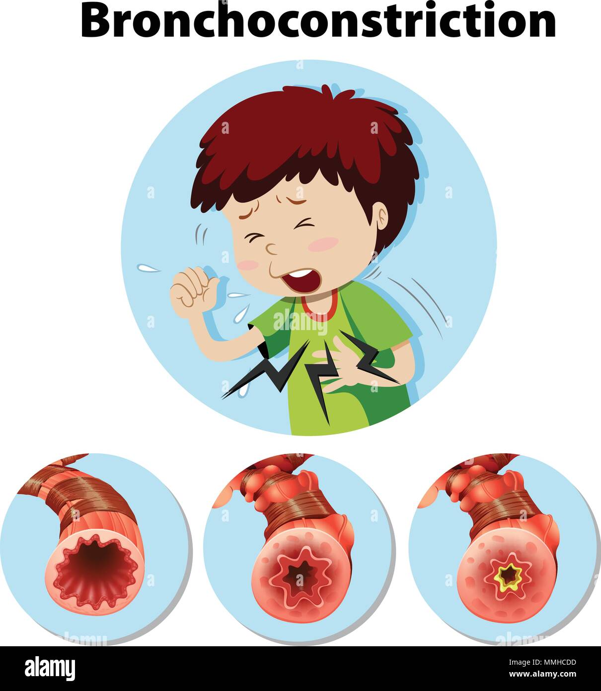 Bronchoconstriction hi-res stock photography and images - Alamy