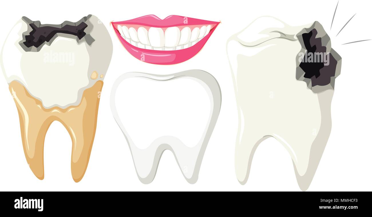 Tooth Decay Illustration Stock Photos & Tooth Decay Illustration Stock ...