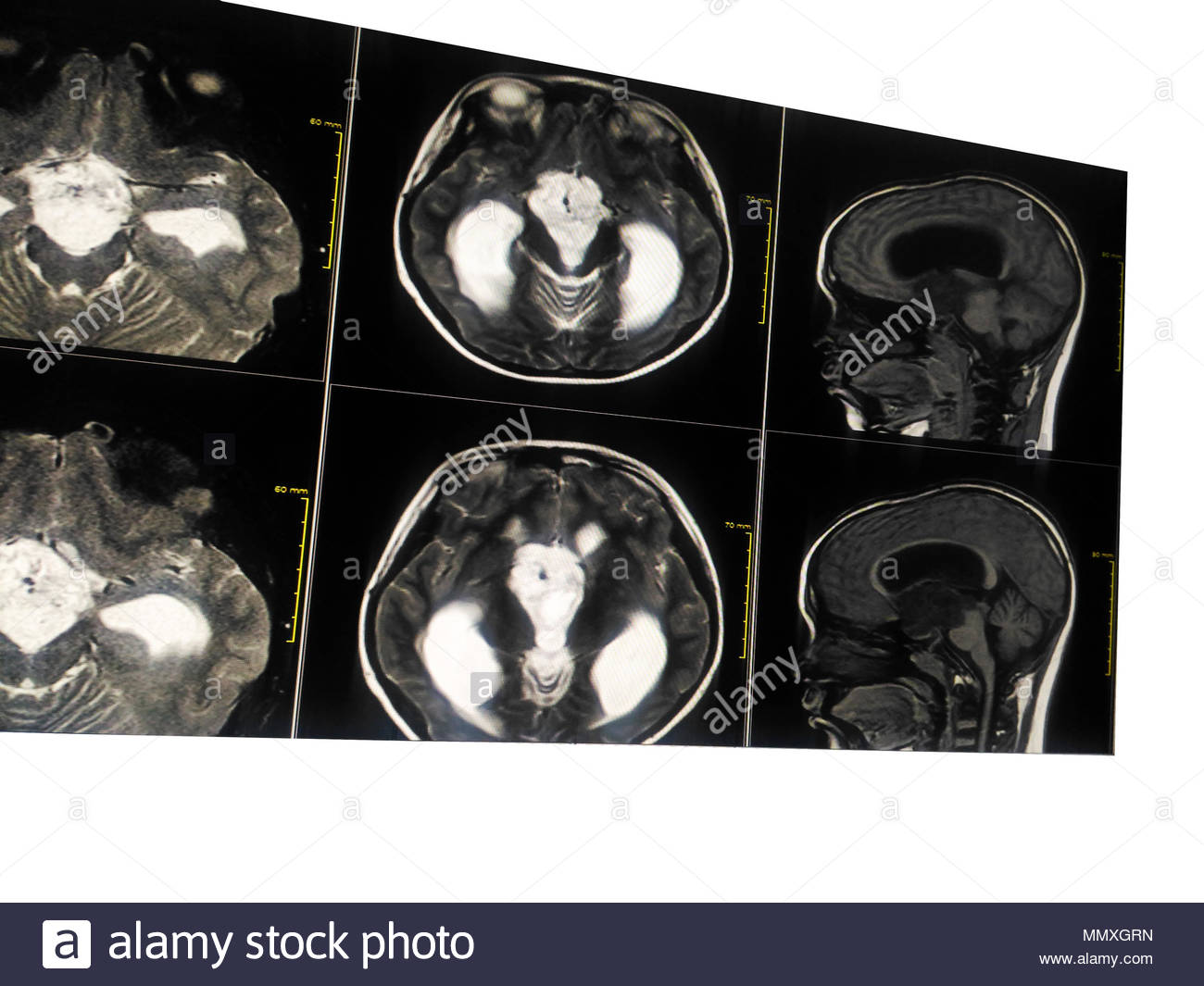 Brain Tumor Film Ct Scan Brain Stock Photos & Brain Tumor Film Ct Scan ...