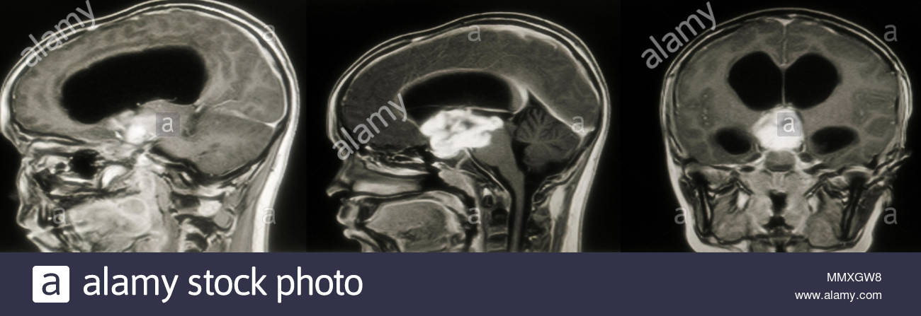Brain Tumor Film Ct Scan Brain Stock Photos & Brain Tumor Film Ct Scan ...