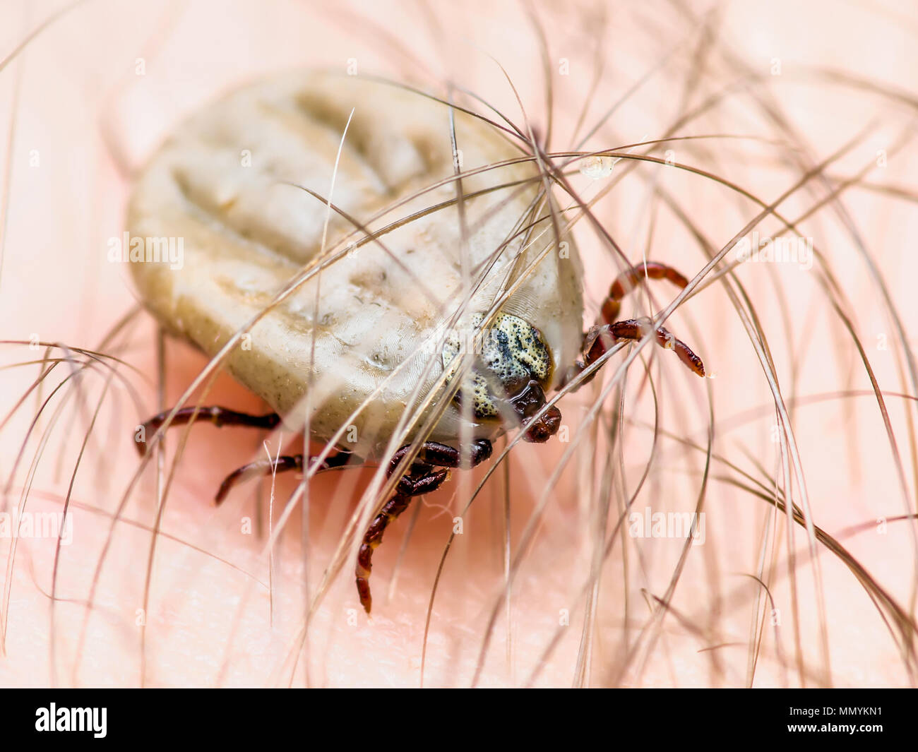 Encephalitis Virus or Lyme Disease or Monkey Fever Infected Tick ...