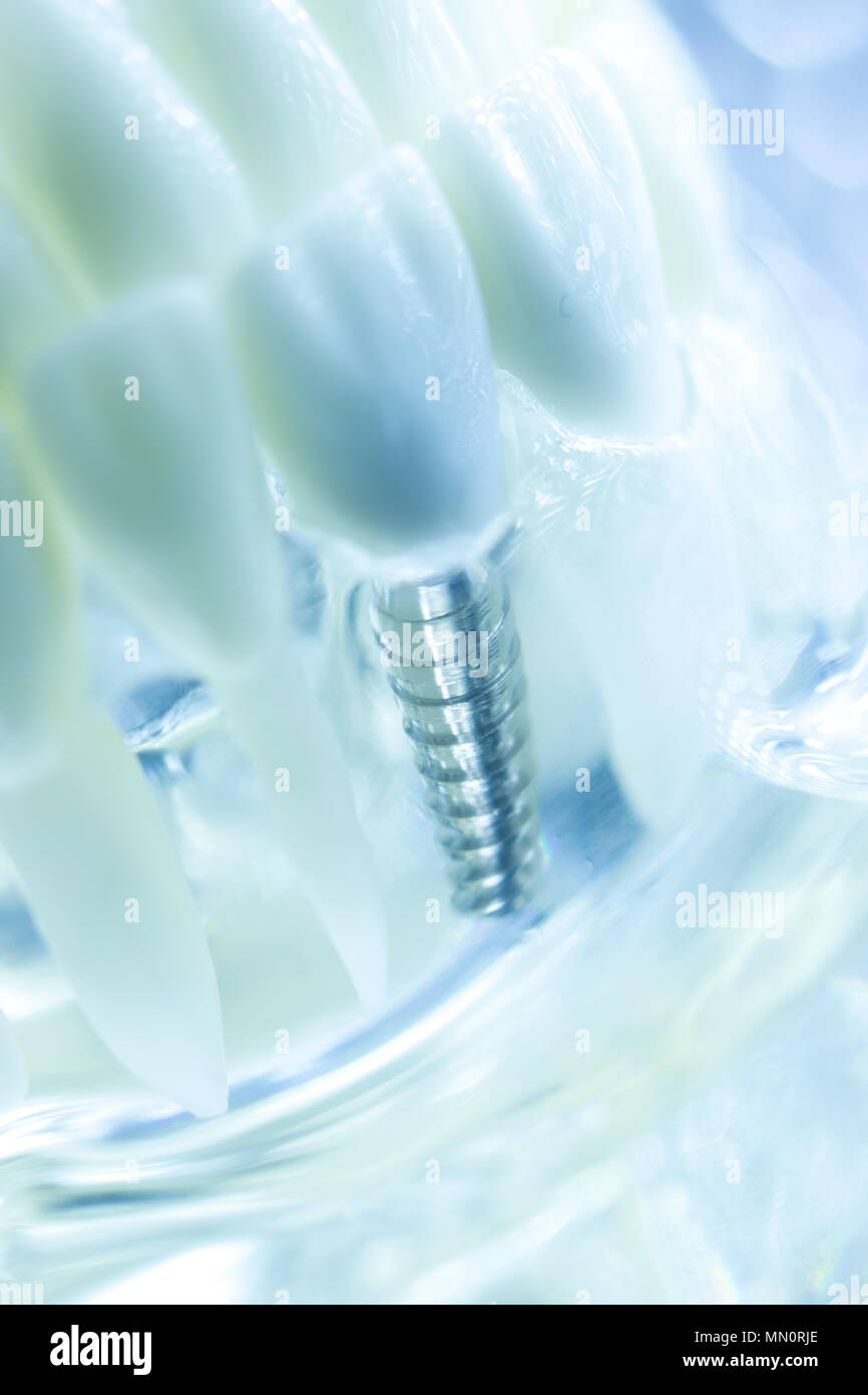 Dental titanium aesthetic orthodontic tooth implant in dentists mouth ...