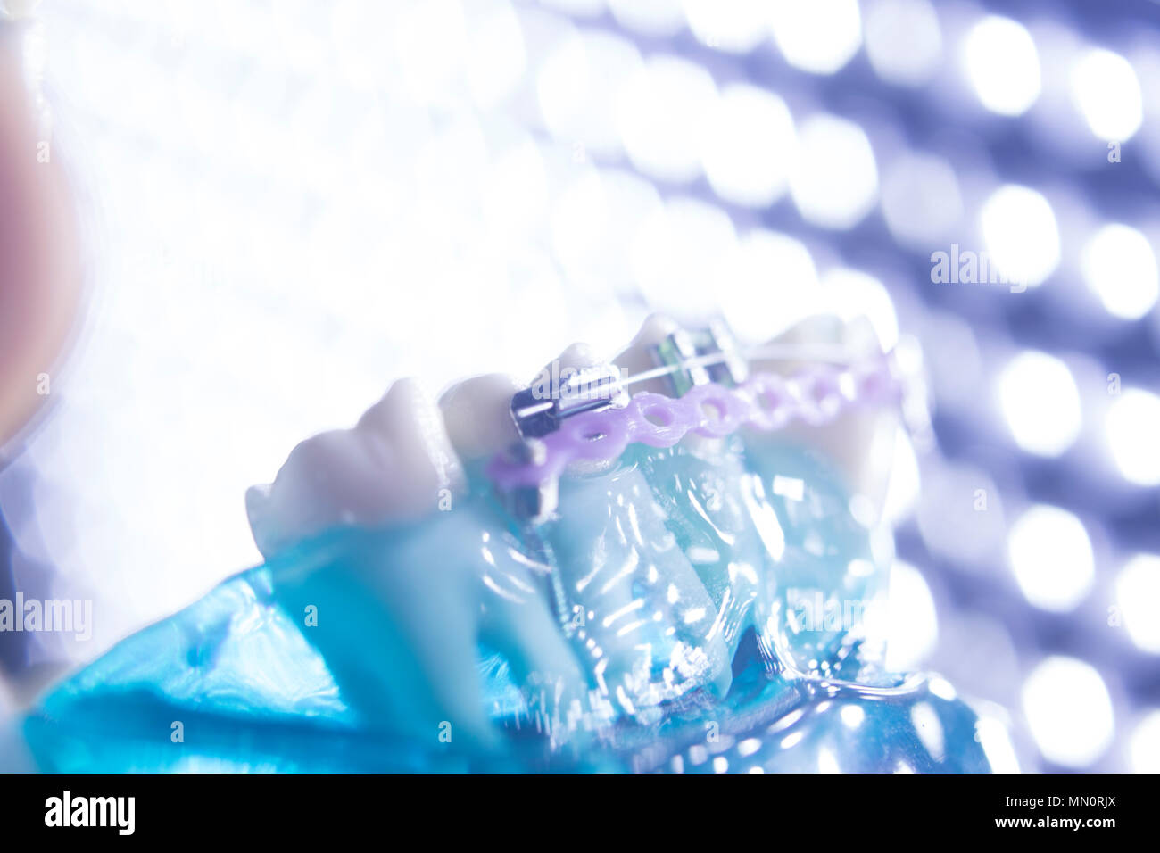 Dental teeth retainers metal aligners brackets to straighten teeth in ...