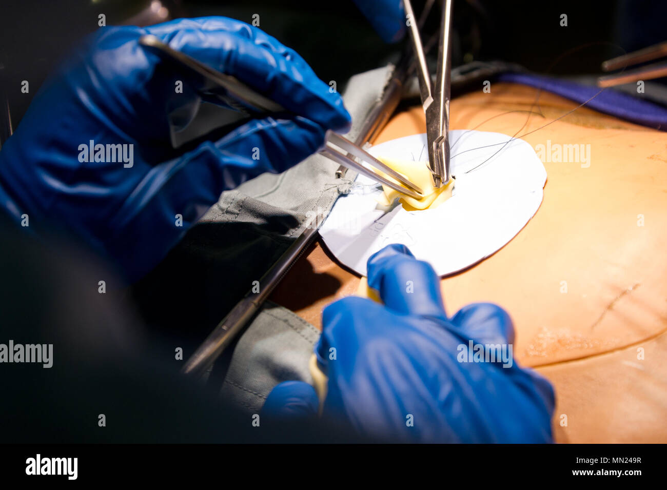 Colostomy surgery hi-res stock photography and images - Alamy