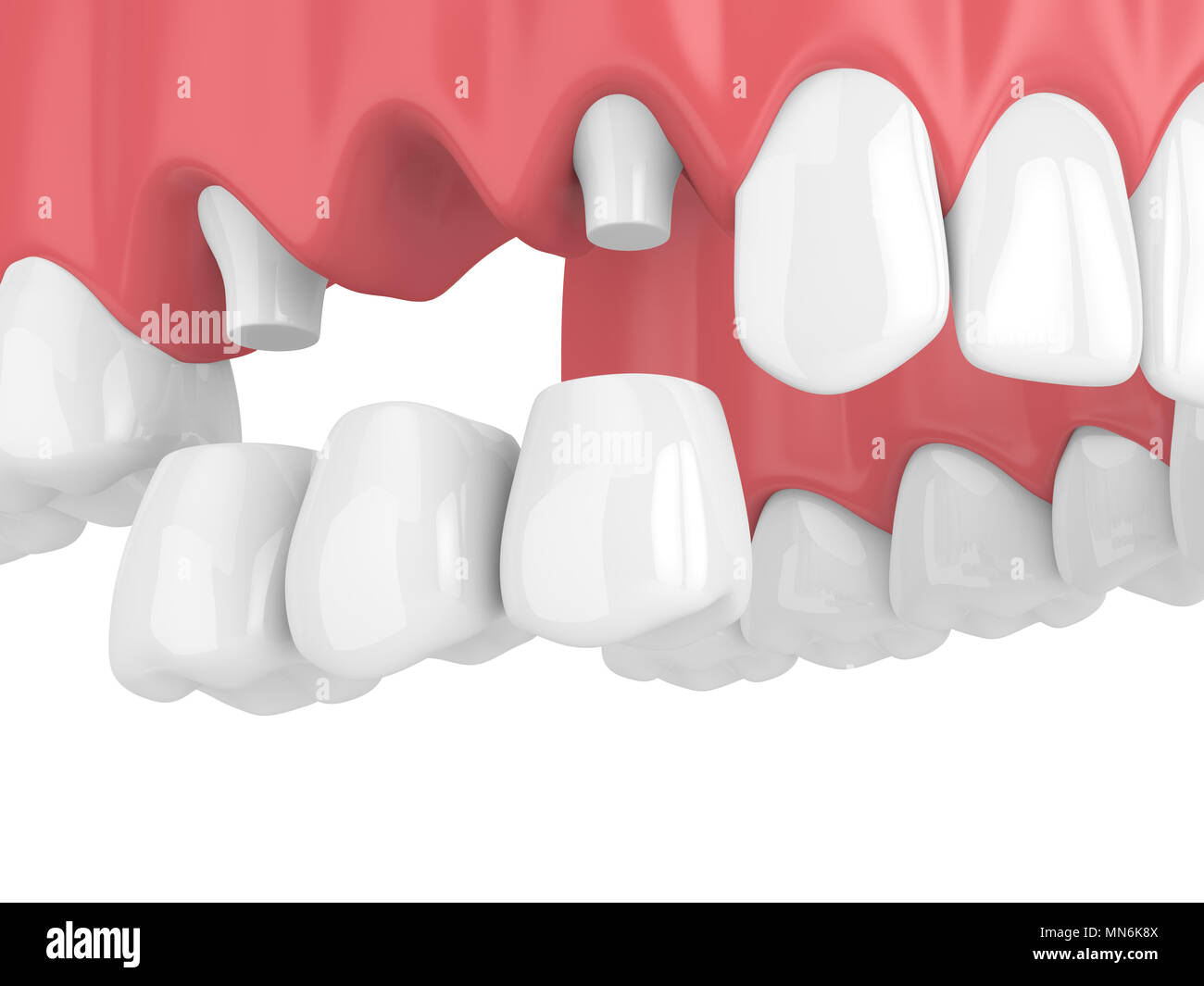 3d render of dental bridge with crowns in upper jaw isolated over white ...