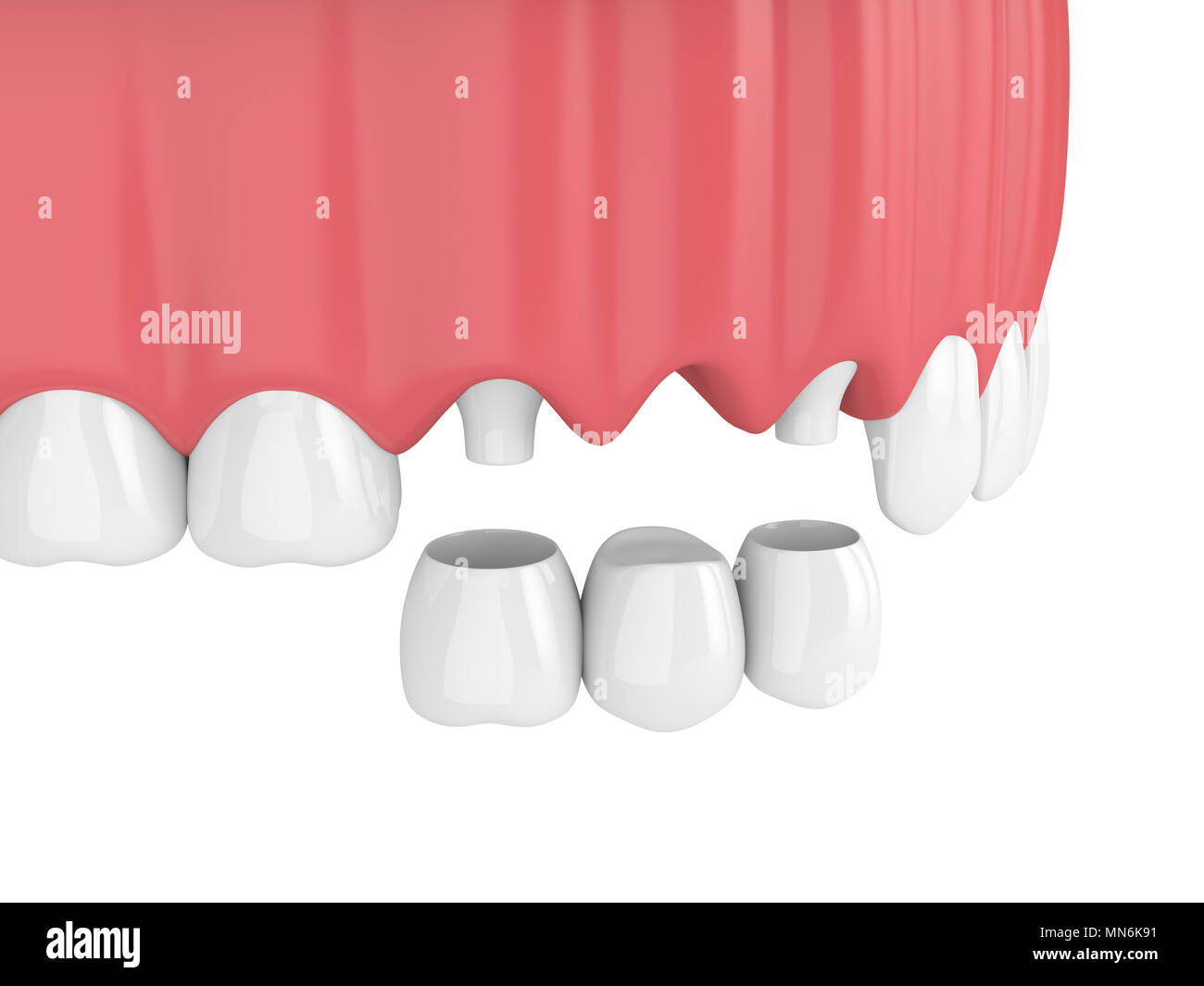 3d render of dental bridge with crowns in upper jaw isolated over white ...