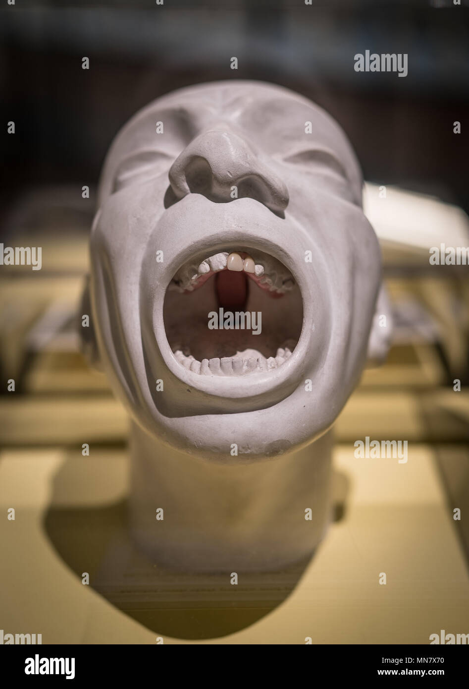 London, UK. 15th May, 2018. Model with cleft palate and prosthesis, an ...