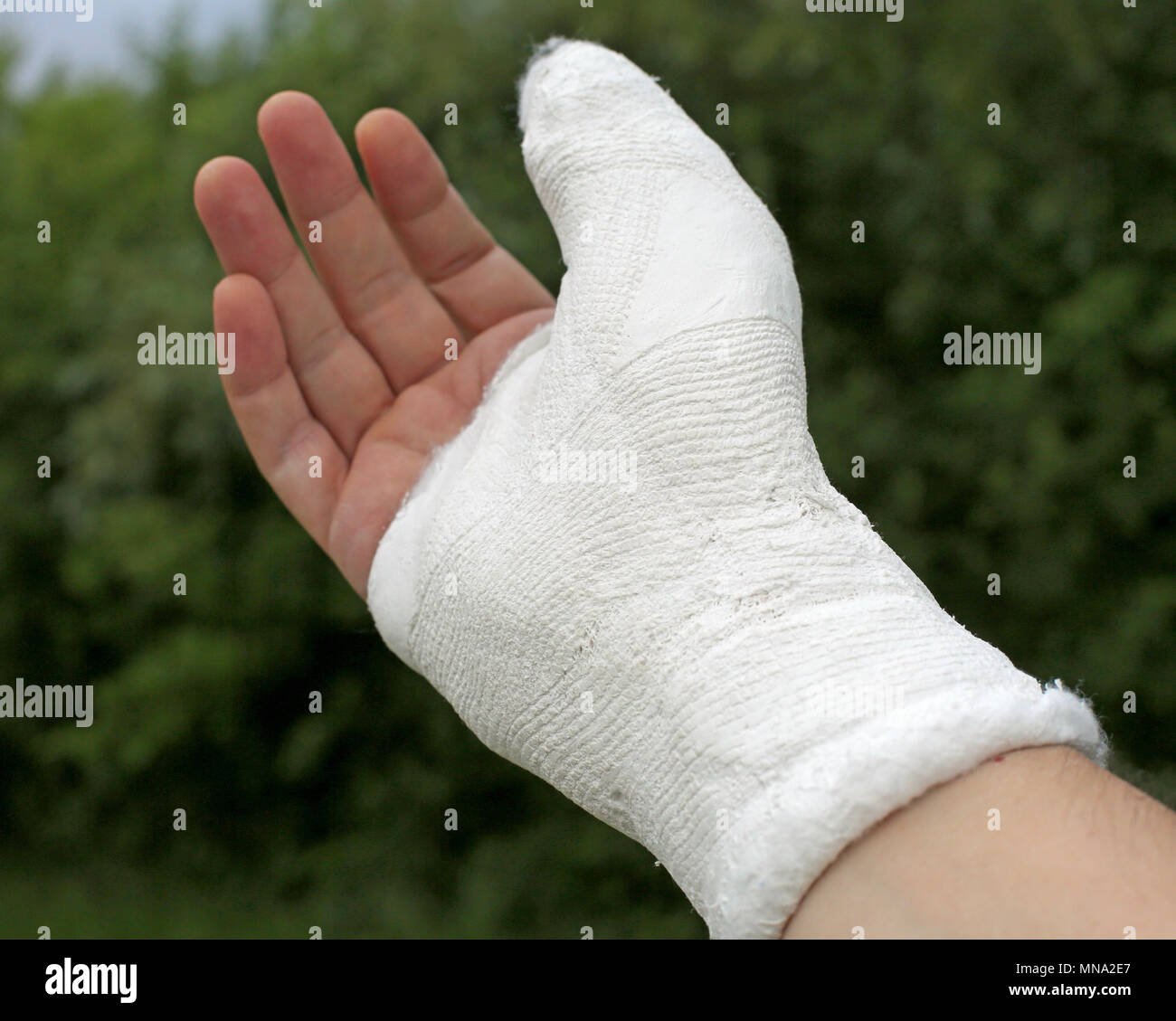 Plaster after wrist fracture hi-res stock photography and images - Alamy