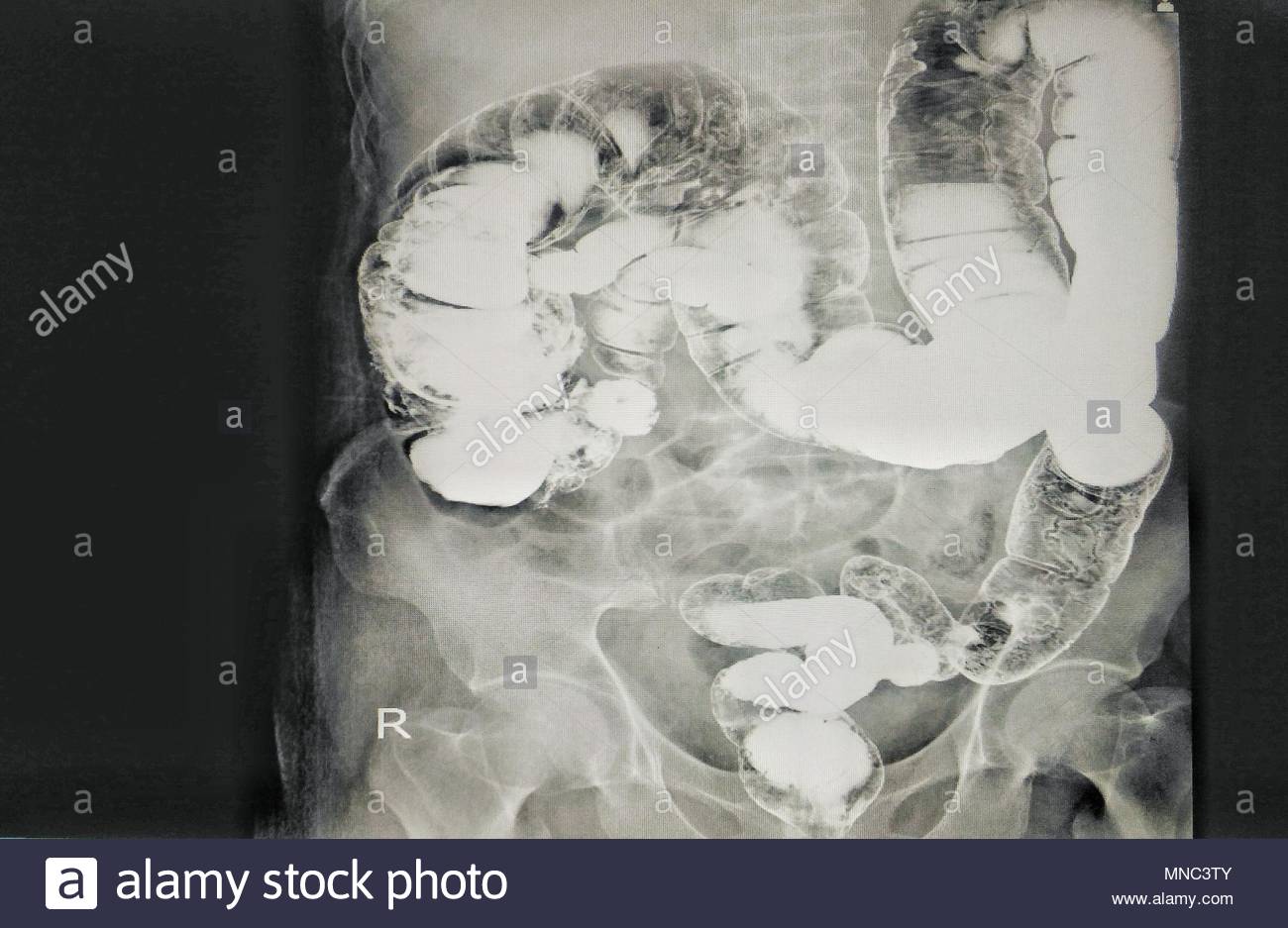 Gastrointestinal Tract Stock Photos & Gastrointestinal Tract Stock ...
