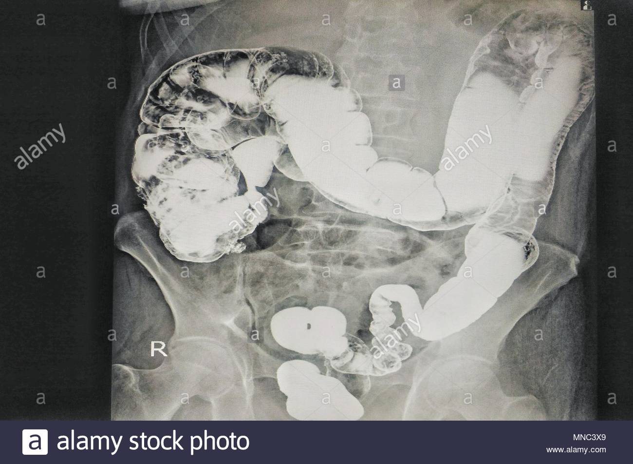 Barium X Ray Stock Photos & Barium X Ray Stock Images - Alamy