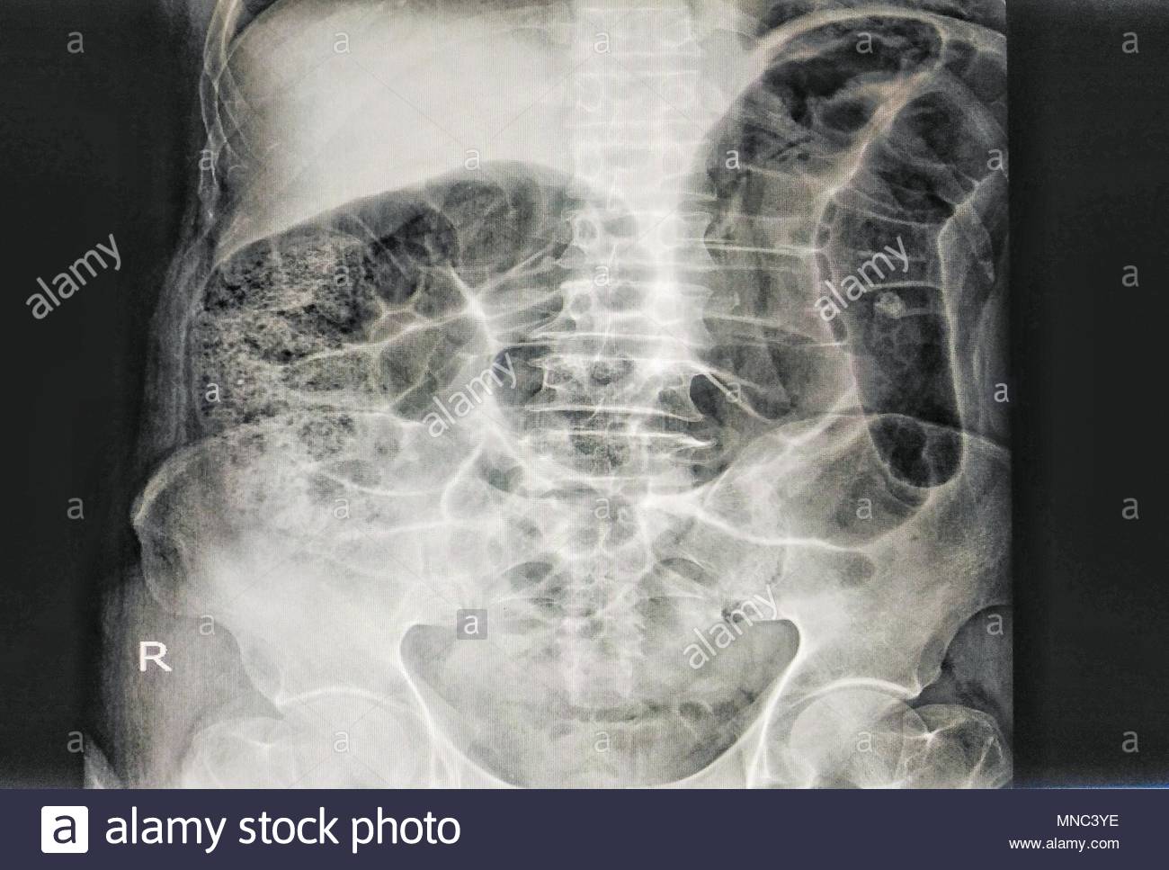 Barium X Ray Stock Photos & Barium X Ray Stock Images - Alamy