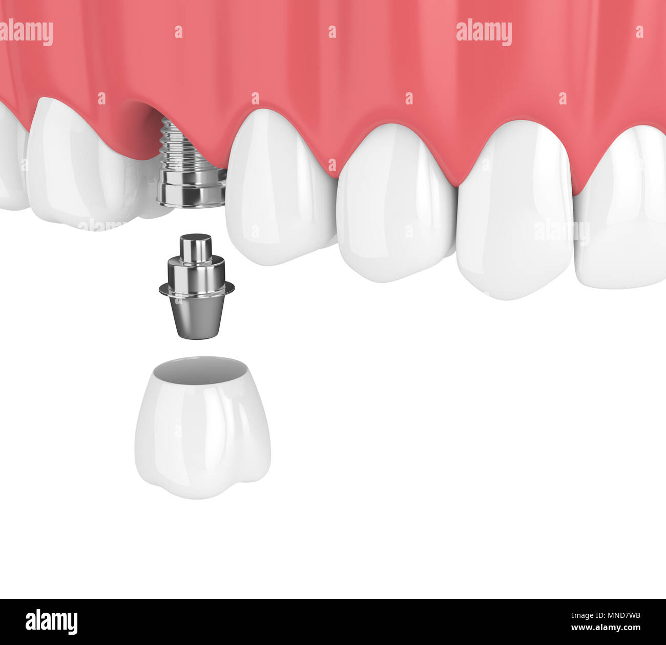 3d render of upper jaw with teeth and dental molar implant over white ...