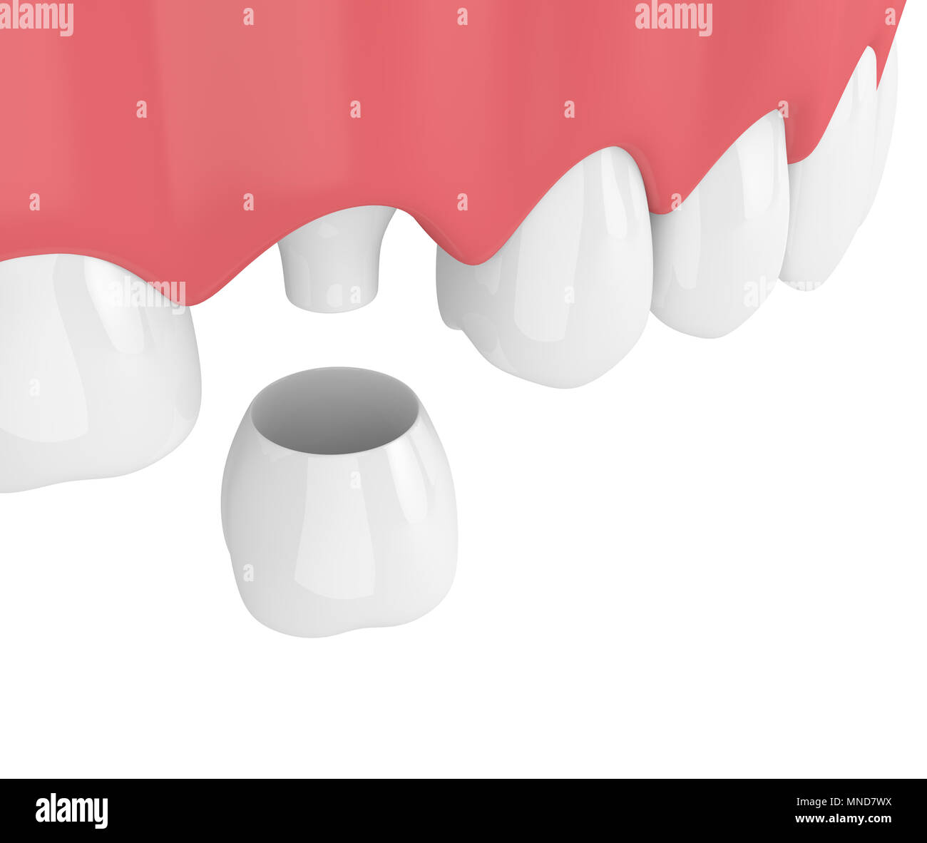 3d render of upper jaw with teeth and dental crown restoration over ...