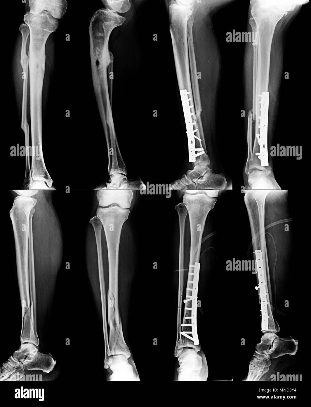 Human joint x ray gray background hi-res stock photography and images ...