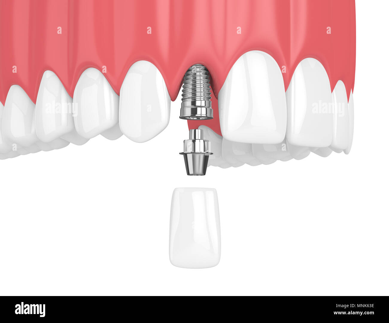 3d render of upper jaw with teeth and dental lateral incisor implant ...