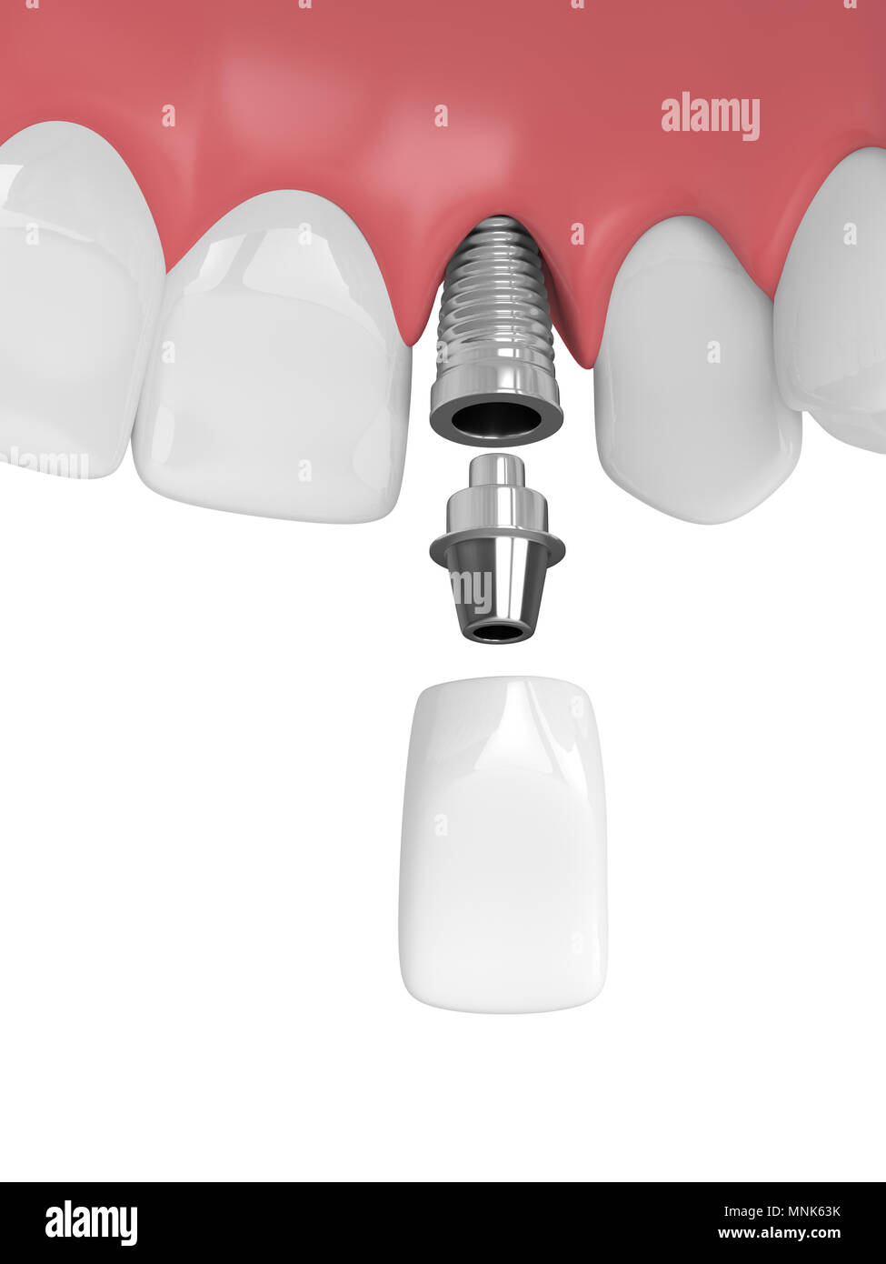 3d render of upper jaw with teeth and dental lateral incisor implant ...