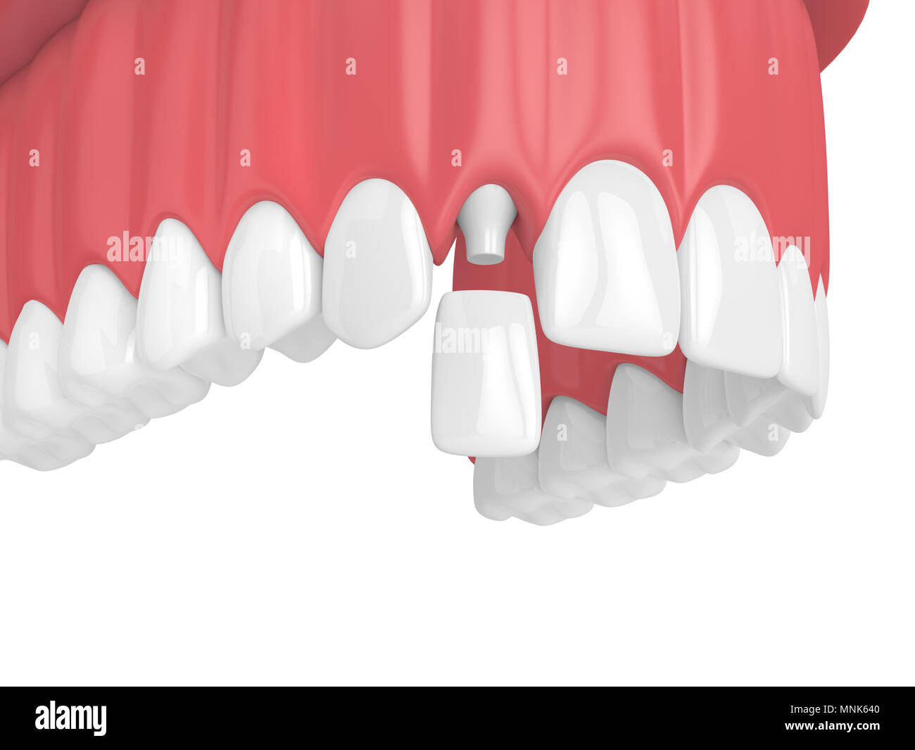 Lateral crown hi-res stock photography and images - Alamy