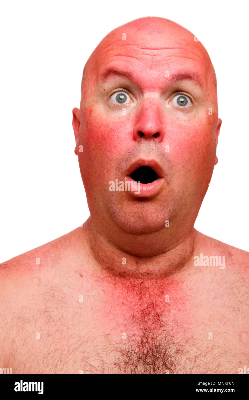 A man shocked as he sees the extent of his sun burn Stock Photo - Alamy