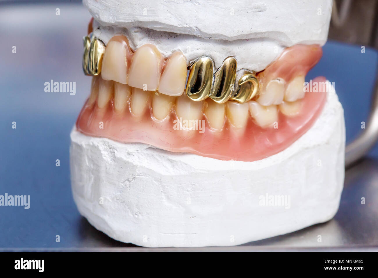 Dental gold teeth prosthesis, clay mold human gums model in jaws ...