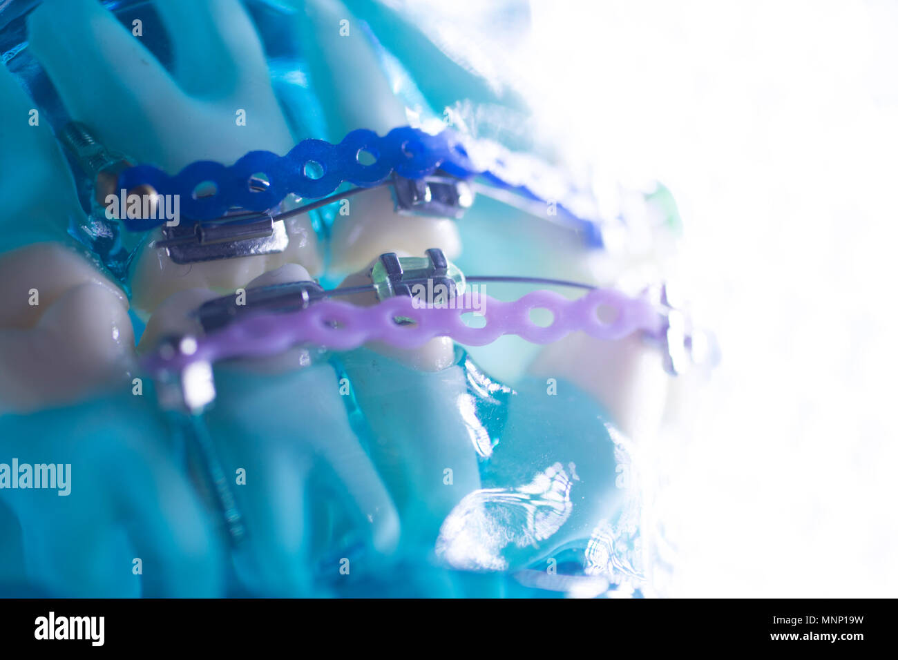 Dental teeth retainers metal aligners brackets to straighten teeth in ...