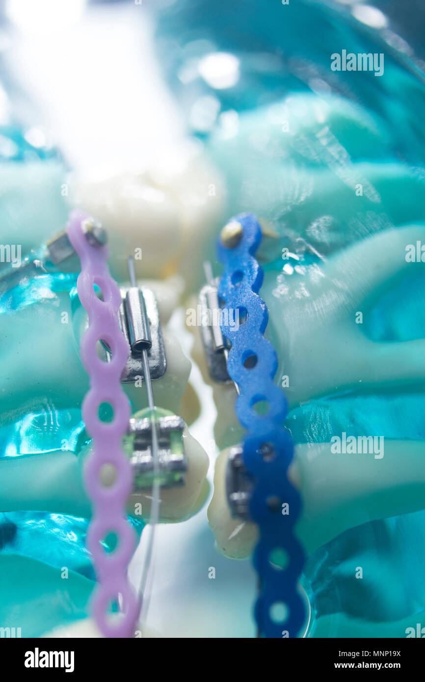 Dental teeth retainers metal aligners brackets to straighten teeth in ...