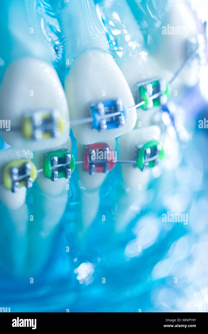 Dental teeth retainers metal aligners brackets to straighten teeth in ...