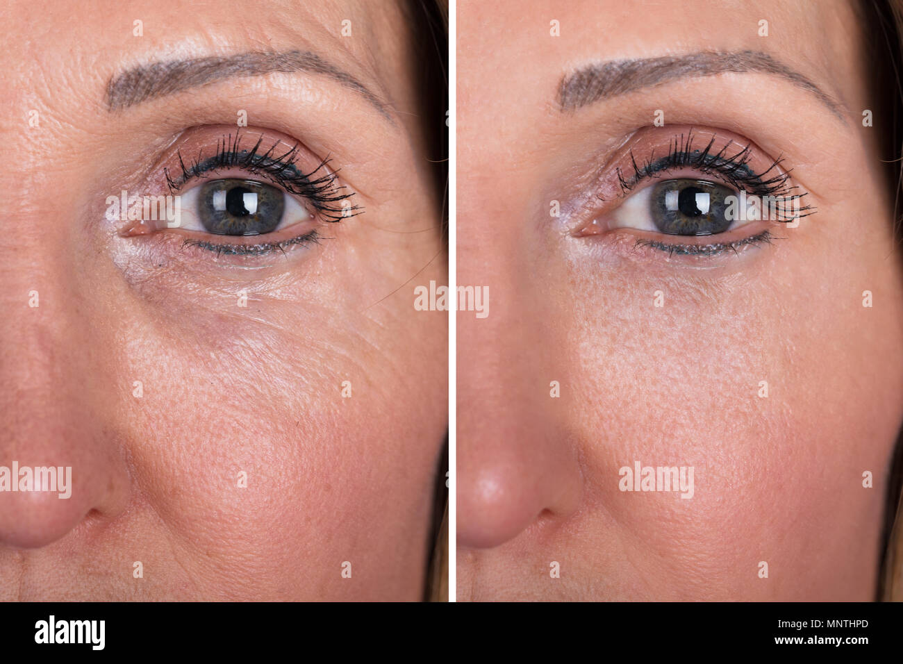 Photo Of Anti-aging Procedures On Caucasian Woman Face Stock Photo - Alamy